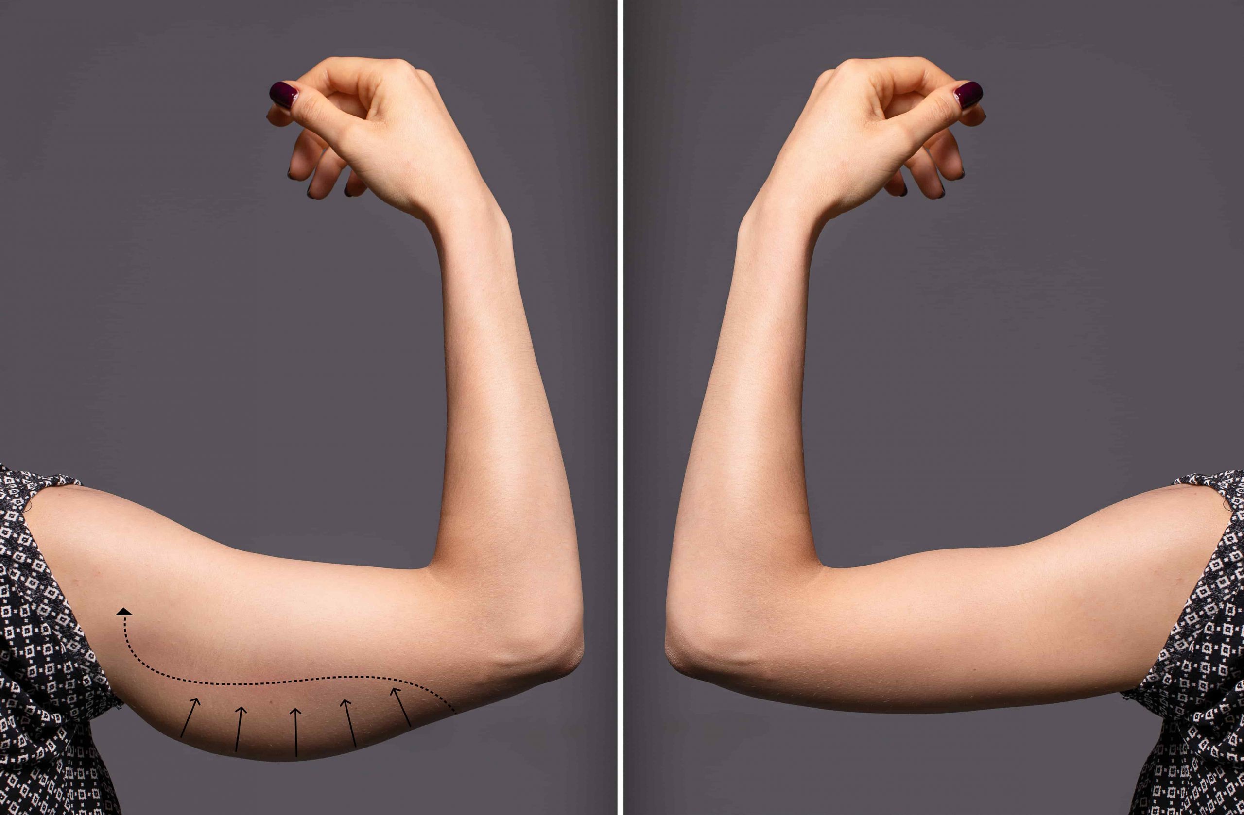 Arm Lifts Everything You Need To Know Dr Finkel MD